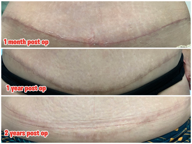 Tummy Tuck Recovery Time - We Got The Funk